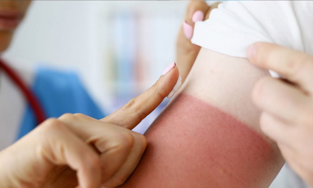 Sun Poisoning Information - Healthopedia.com