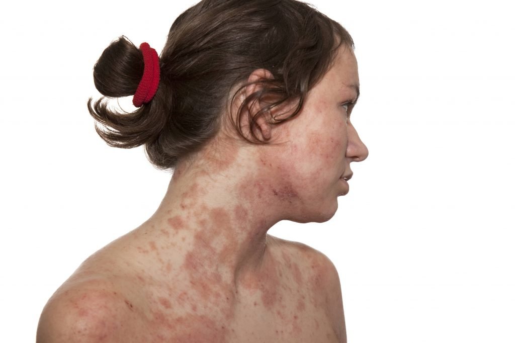 Dyshidrotic Eczema - Healthopedia UK